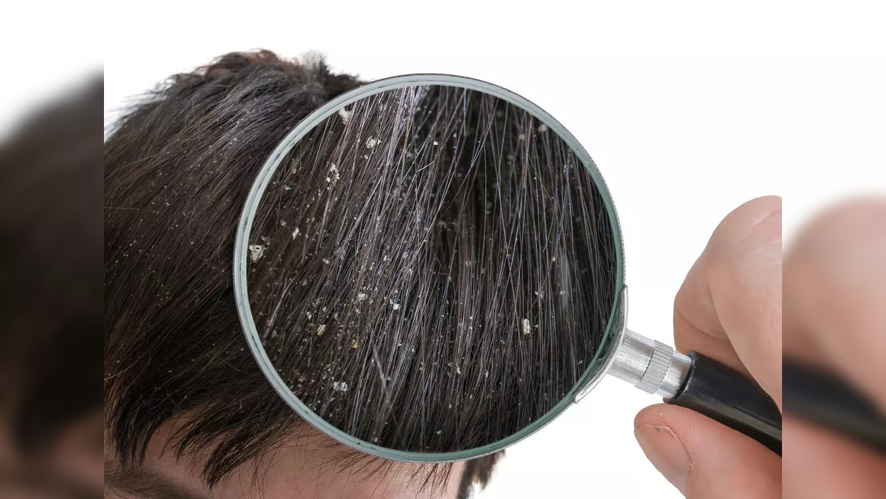 Dandruff: Know the causes and methods of prevention | Health News ...