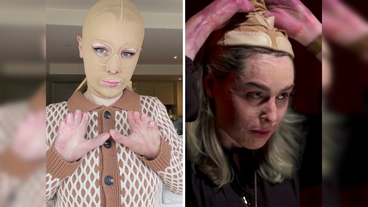 Volcano eruption survivor removes her face mask for the first time ...