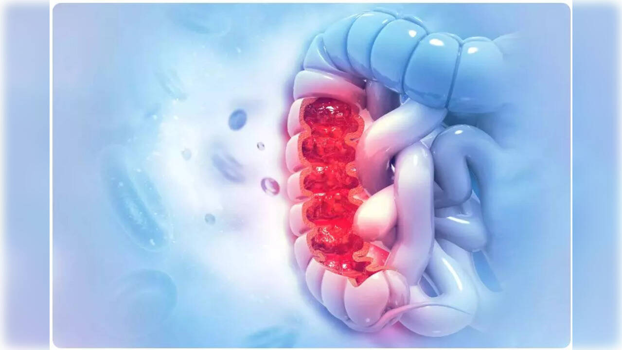 Chronic constipation: Did compacted stools cause Elvis Presley's death ...