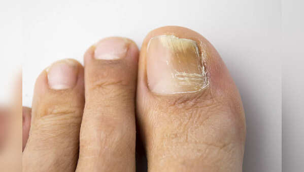 What do toenails say about your health? | Health News, Times Now