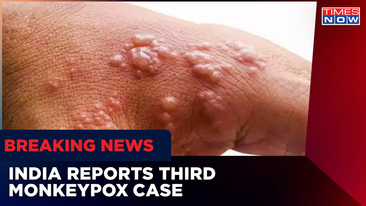 Monkeypox Update | Kerala Reports Another Case Of Monkeypox, India's ...