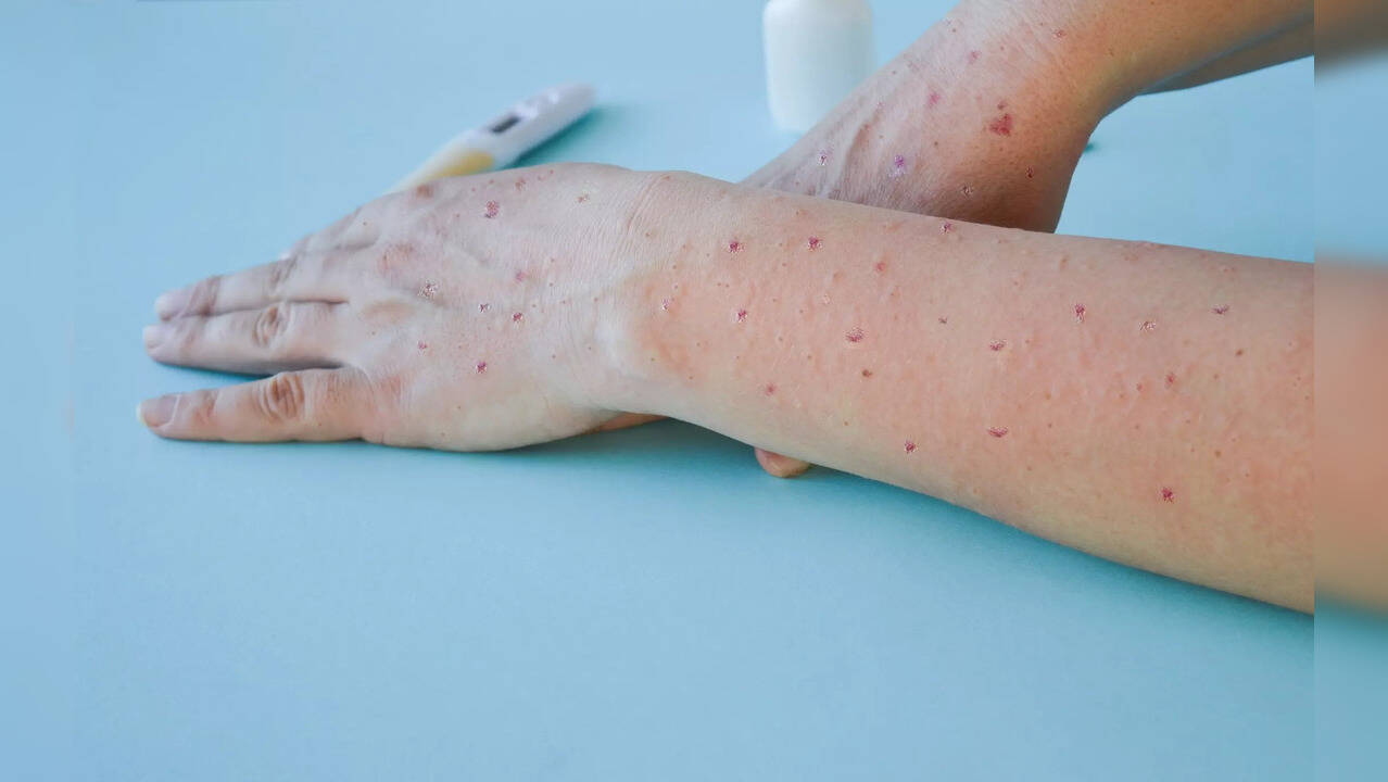 Explained: How Monkeypox spreads; how to prevent it