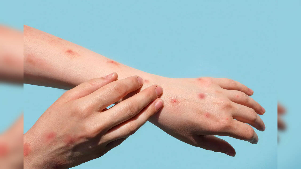 A single lesion could also hint at monkeypox infection: UK Health agency