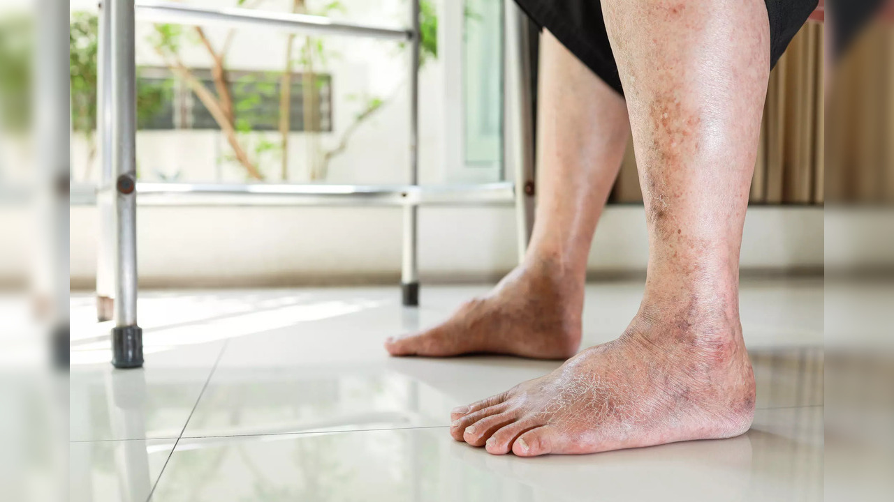 High cholesterol: The colour of your legs could be a symptom | Health ...