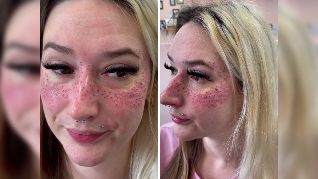 Bizarre: Woman travels 1,400 km to get tattoo of 'freckles' on her face ...