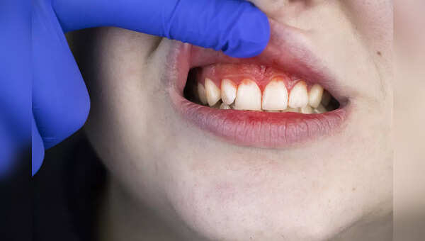 Are your gums hurting? This could be mouth ulcers, know the other ...