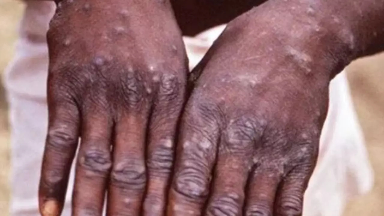 Second monkeypox death reported in United States as virus linked to ...