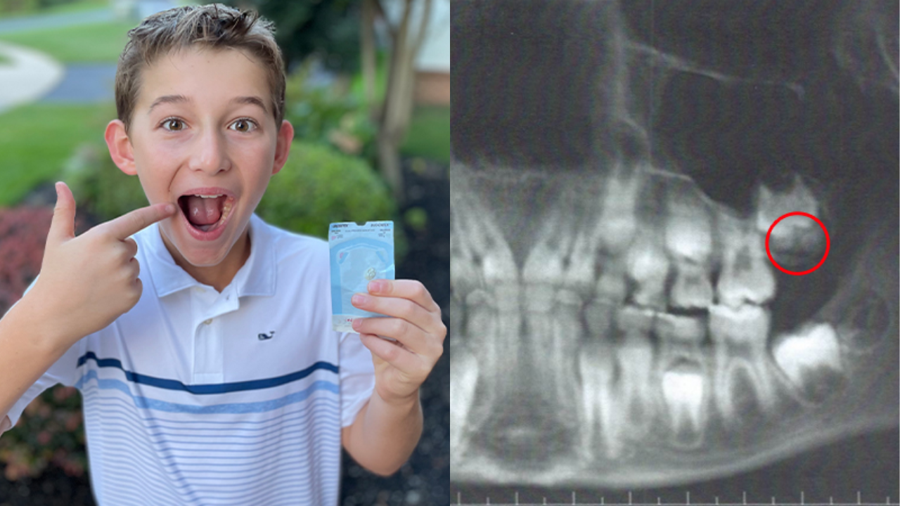 9-year-old becomes the youngest to ever have a wisdom tooth removed ...