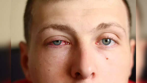 BMC advisory on Conjunctivitis cases spike: Here's how to ensure your ...
