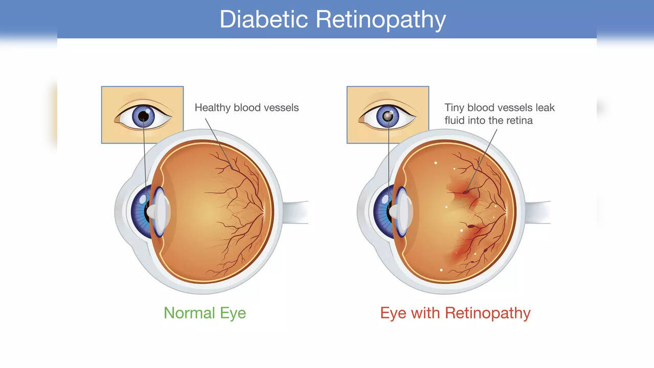 Diabetic Retinopathy: Signs and symptoms, stages, and treatment ...