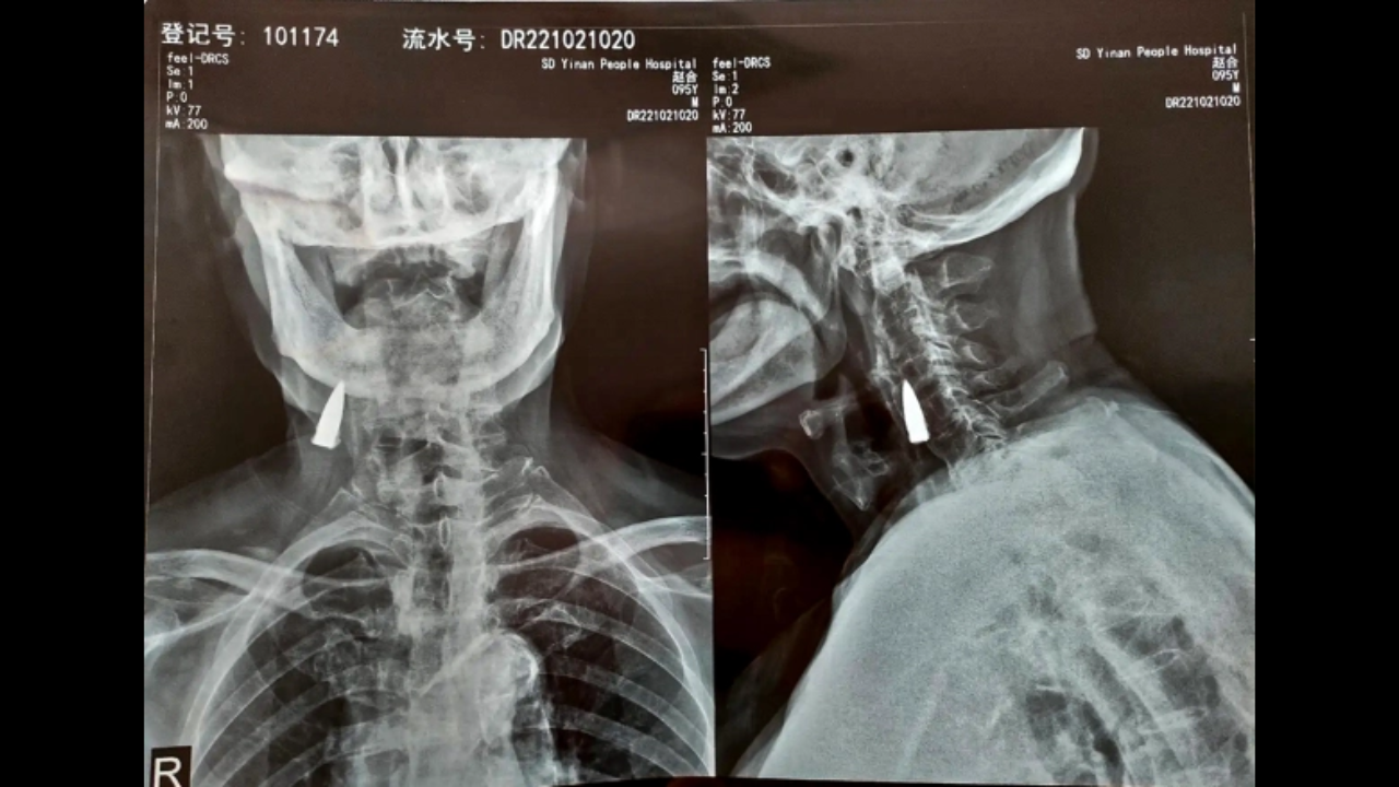 X-ray reveals bullet lodged in war hero's neck for 77 years | Viral ...