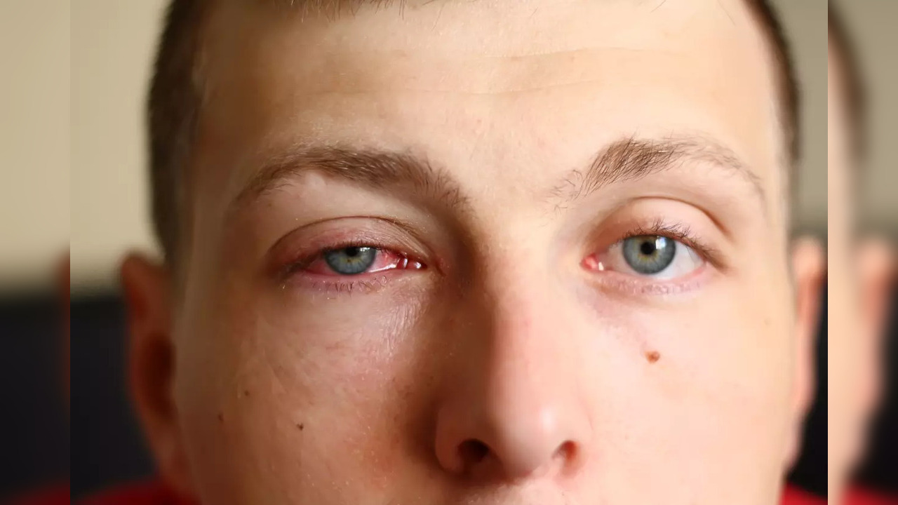 Madras Eye: Tamil Nadu reports over 4,500 conjunctivitis cases daily ...