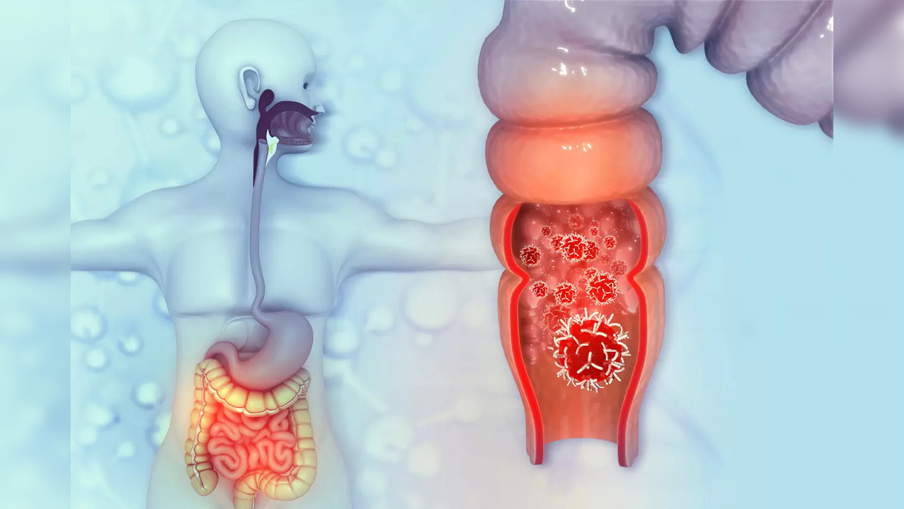 What is colon cancer -- silent killer that afflicted Kristie Alley and ...