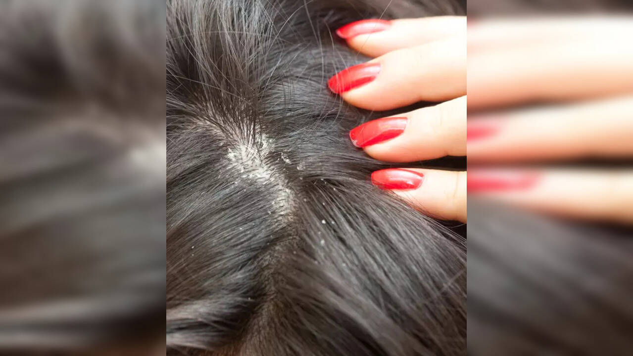 Best foods to eat to reduce dandruff naturally