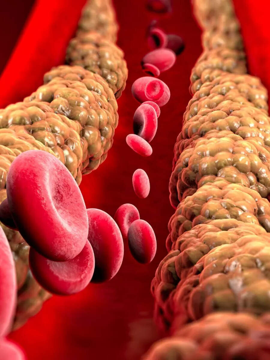 Top 5 Effortless Ways To Reduce Cholesterol Without Statins Times Now
