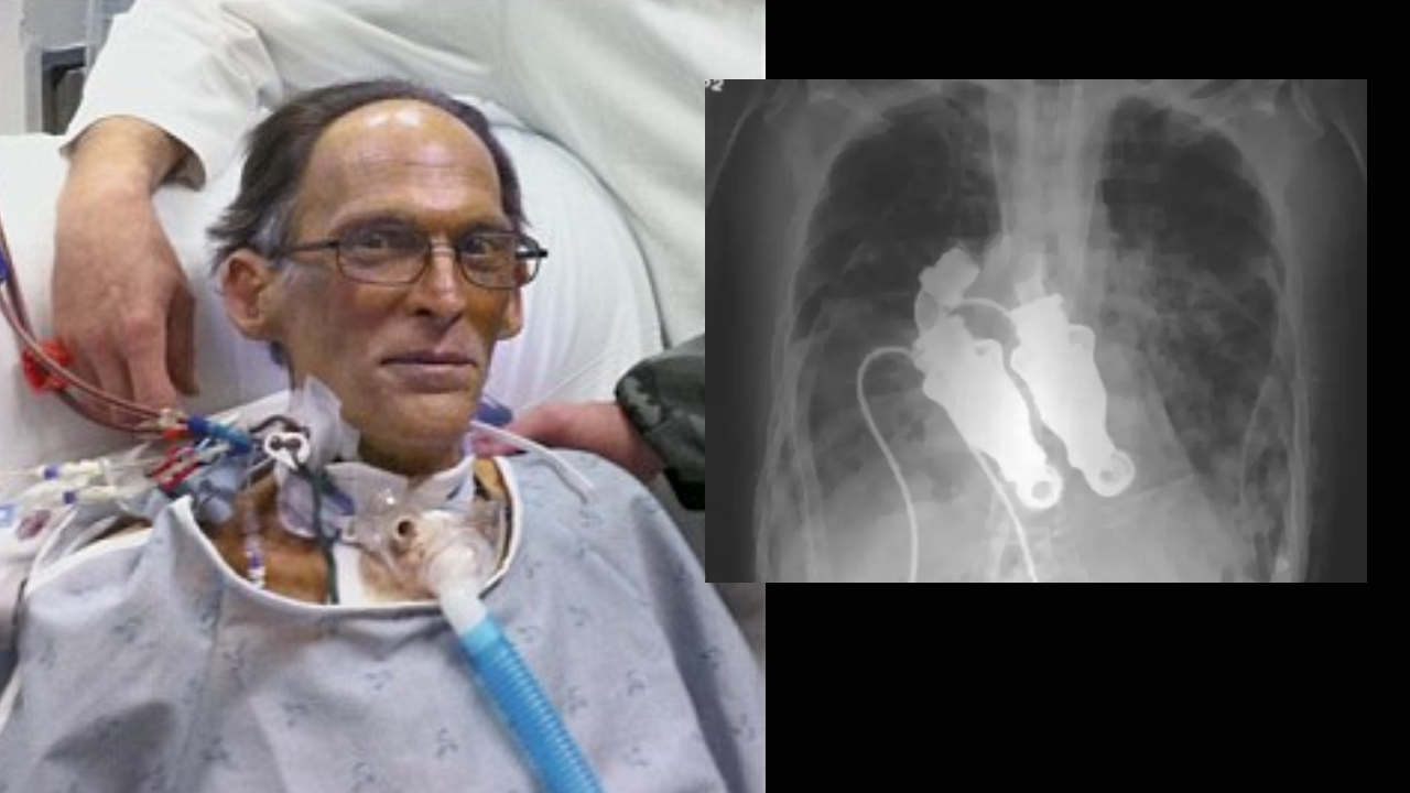 World's first heartless human was able to live without a pulse | Times Now