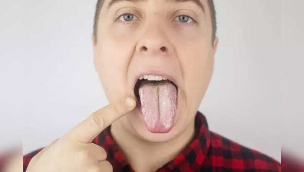 Ever noticed a peculiar white rash on your tongue? Know all about oral ...