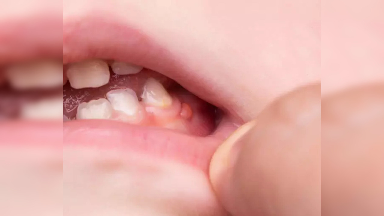 Beware! A simple gum infection can cause a deadly heart disease | Health News, Times Now