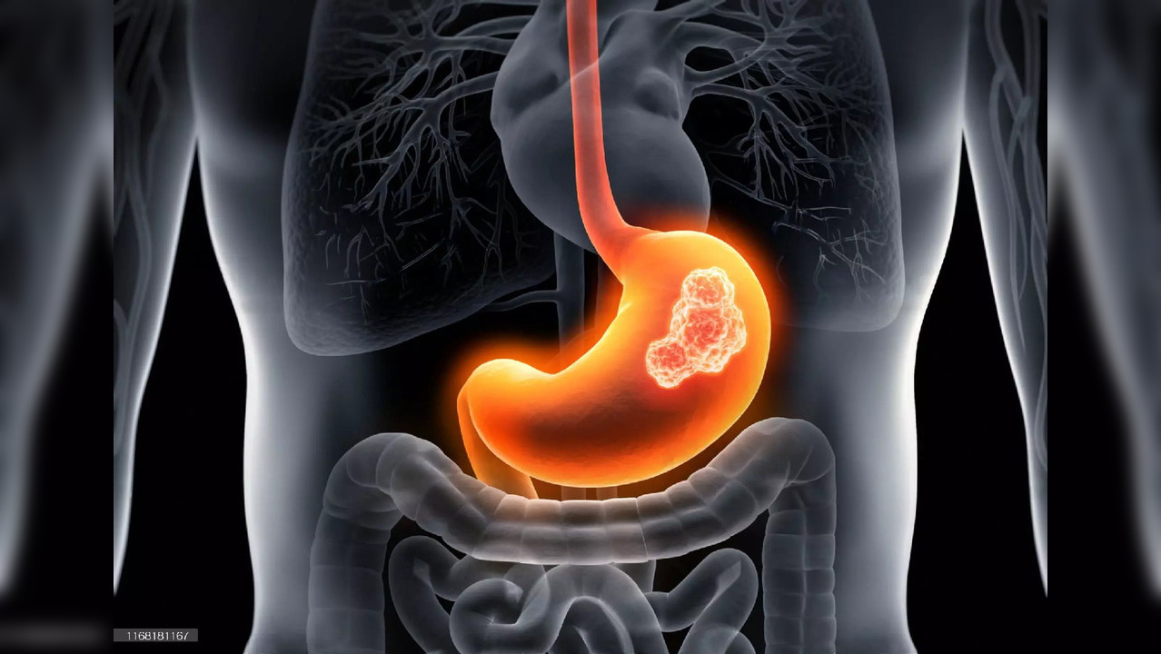 Gastronomical Cancer: Know its symptoms and early signs to take timely ...