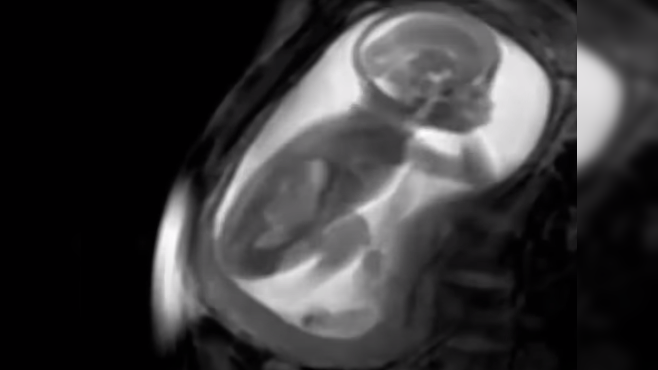 This MRI footage of a 20-week-old foetus is going viral because ...