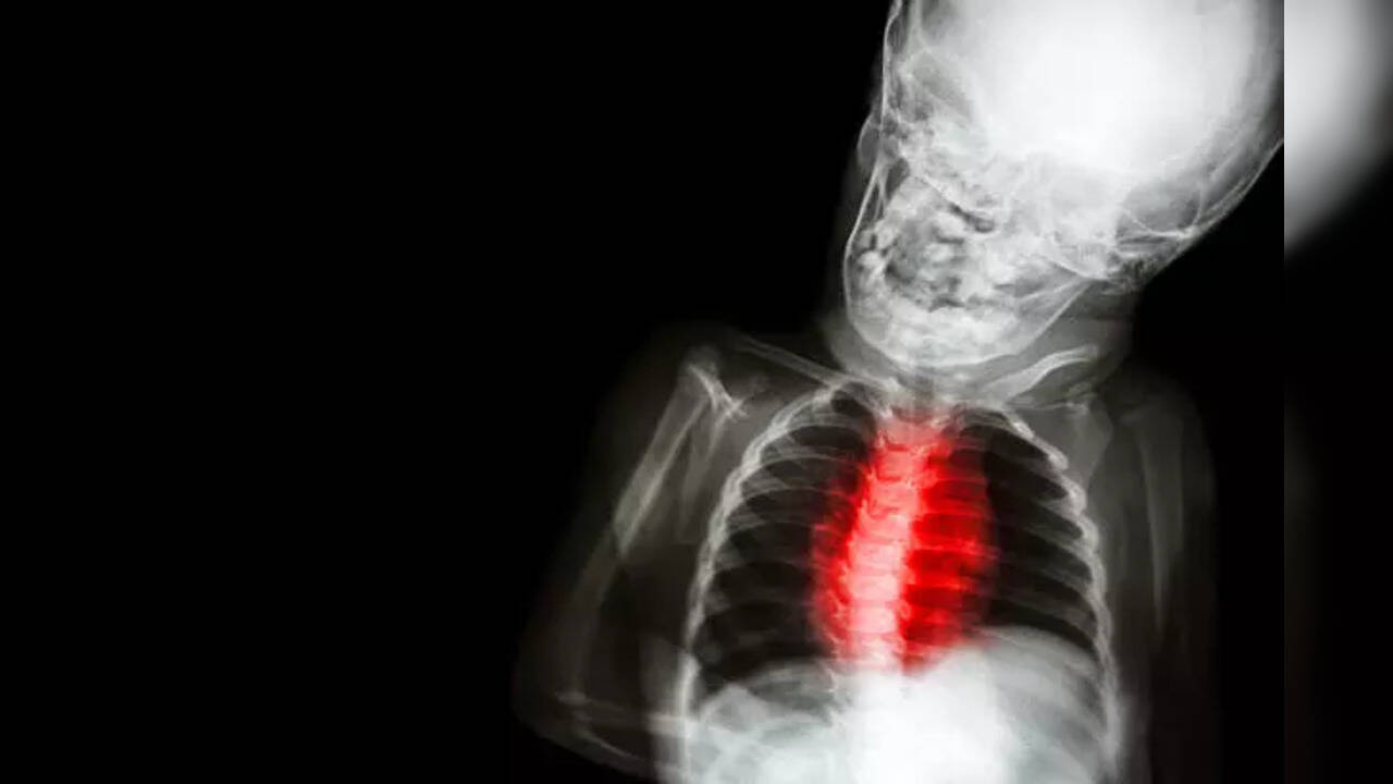 Congenital heart disease: Know all about cardiac irregularities ...