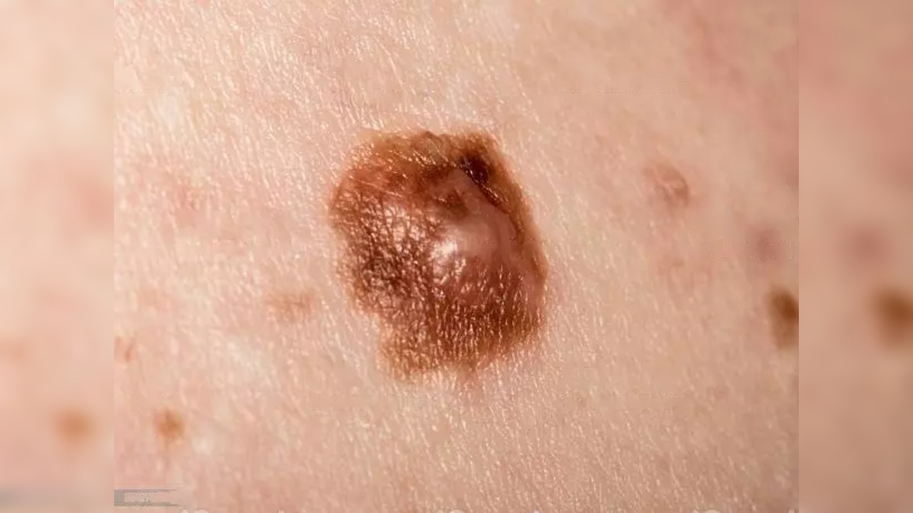 How to recognise early signs and symptoms of skin cancer | Health News ...