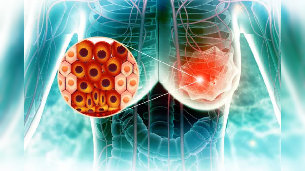 5 signs that the deadly Metastatic breast cancer has spread to your ...