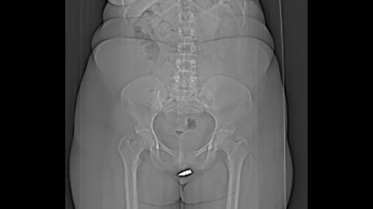 Women Has Bullet Removed From Clitoris In Incredible 'First Of Its Kind ...