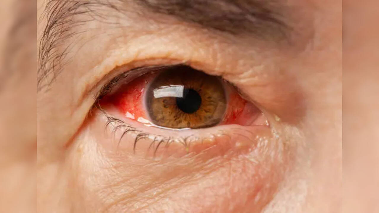 Man Dies Of A Horrific Eye Bleeding Disease Sparking Fears Of An ...