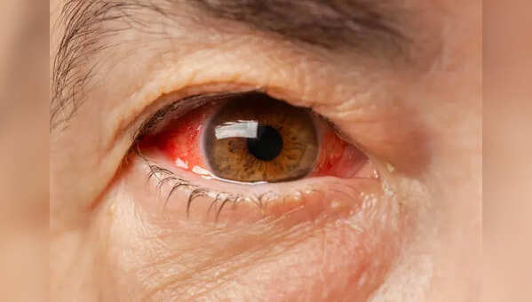 Man Dies Of A Horrific Eye Bleeding Disease Sparking Fears Of An ...