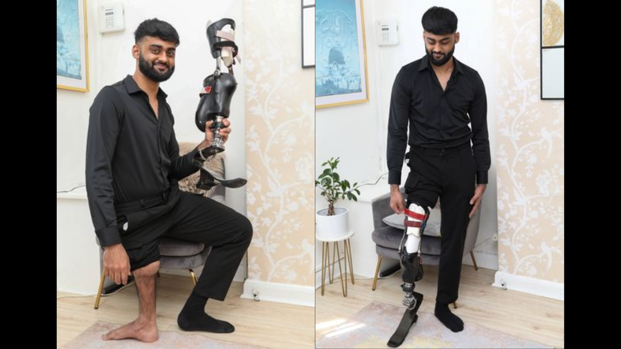 Man Who Had Leg Amputated And Foot Sewed Backwards Says It Saved His ...