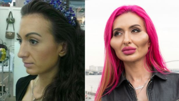 Model With 'World's Biggest Cheeks' Shares What She Looked Like Before ...