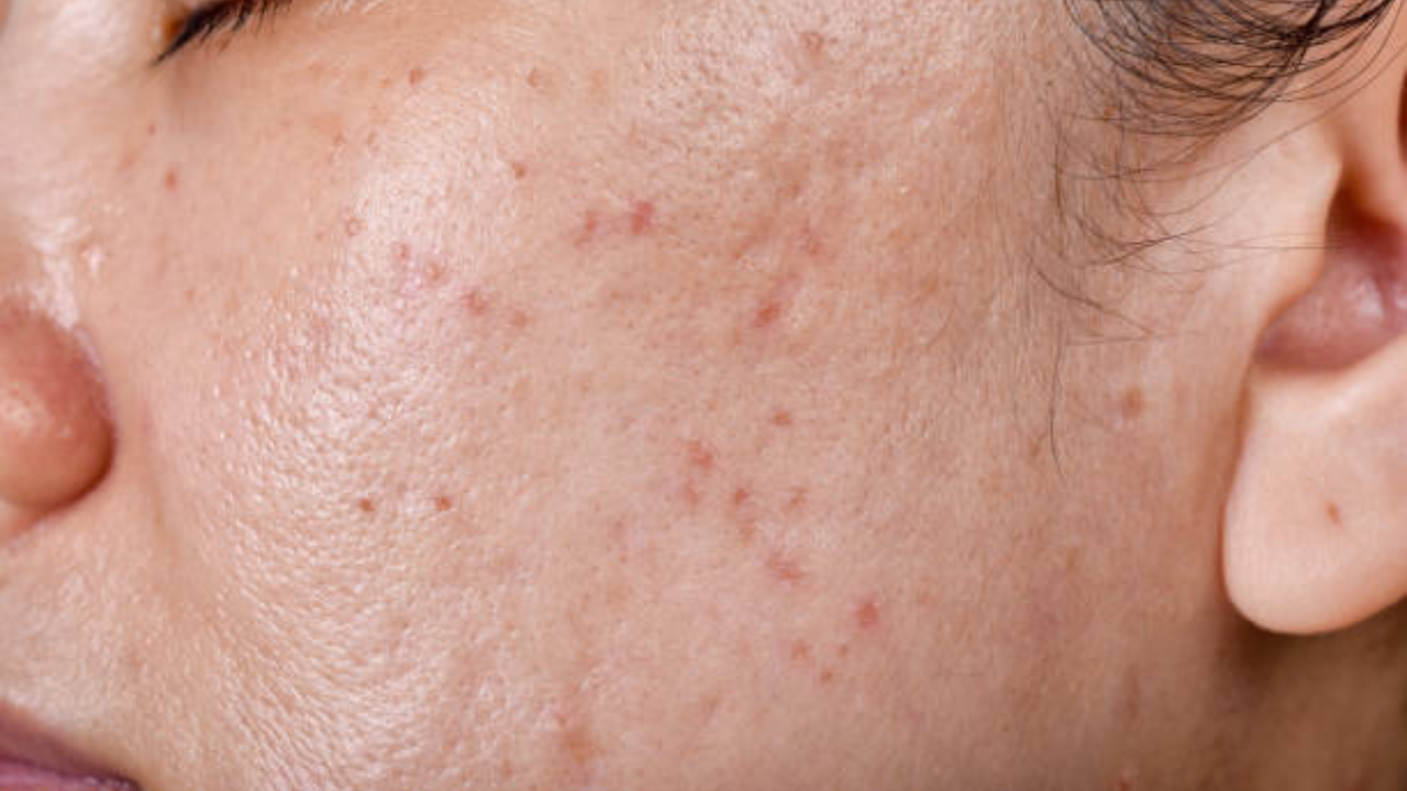 Blind Pimples: What They Are and How to Get Rid of Them | Lifestyle ...